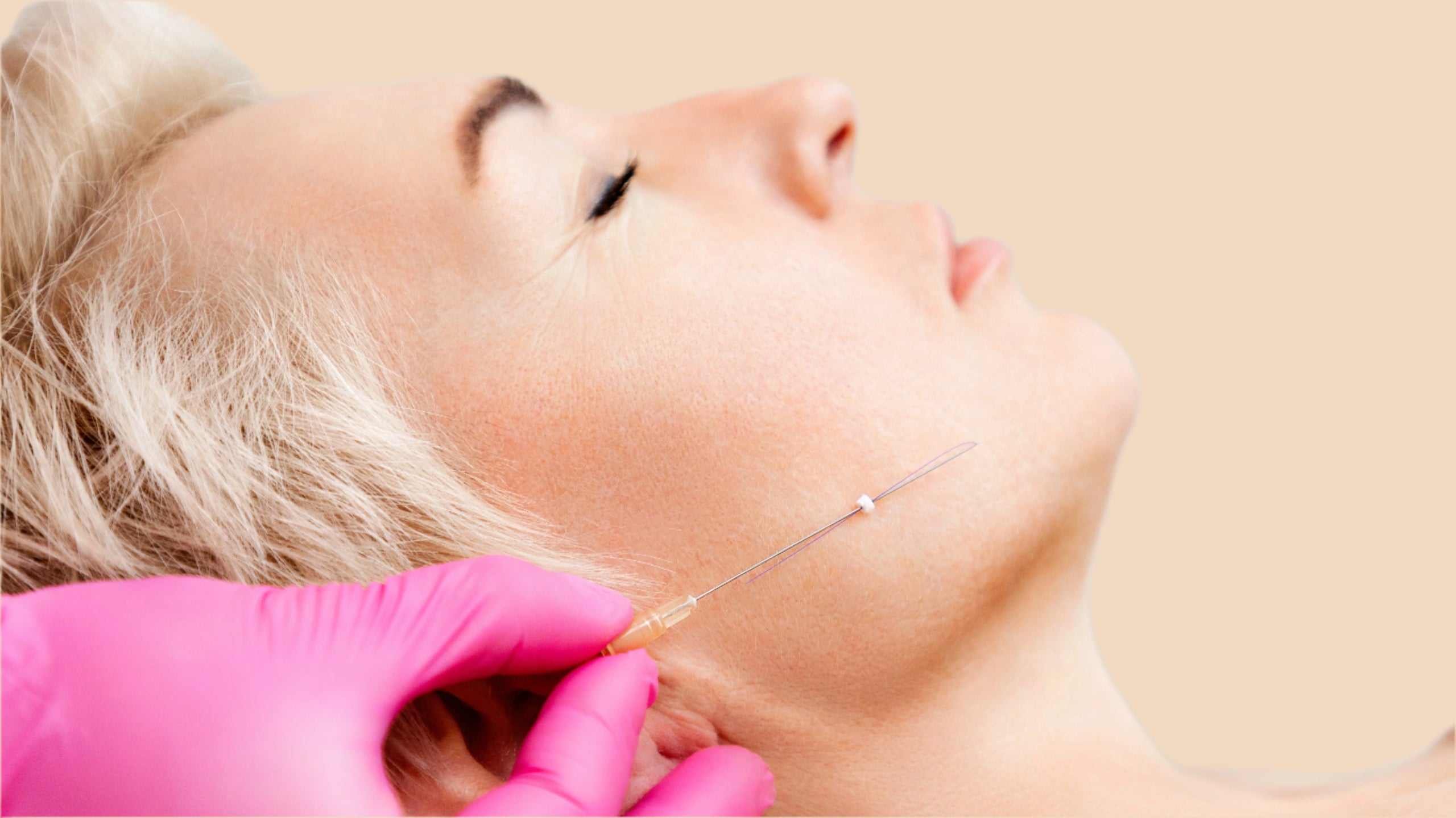 PDO Thread Lift Treatments – PRISM Aesthetics