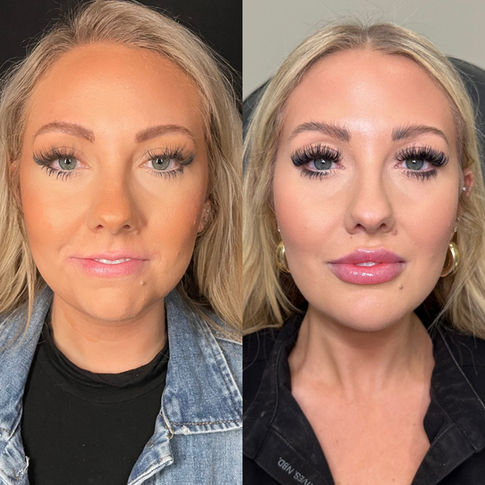 Before After – PRISM Aesthetics