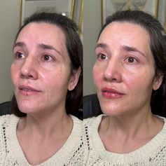 Before After – PRISM Aesthetics